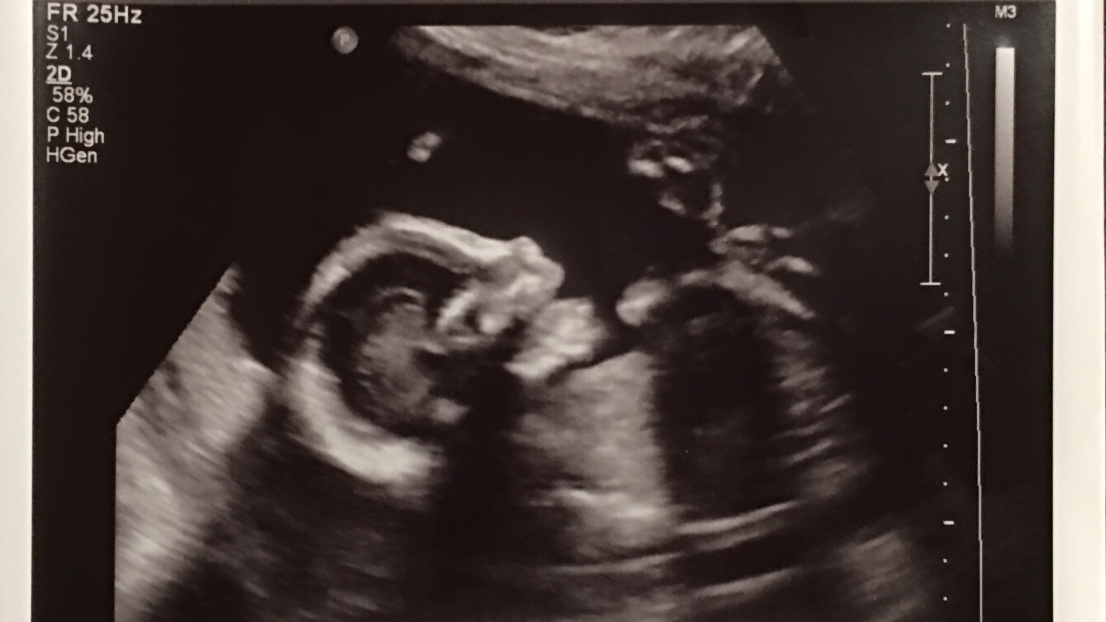 CDH International - A Global Initiative to Stop Congenital ...