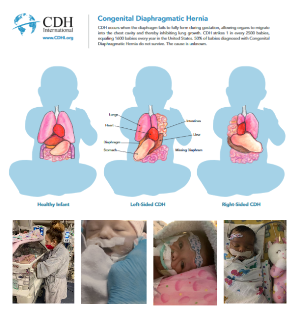 CDH International - A Global Initiative to Stop Congenital ...