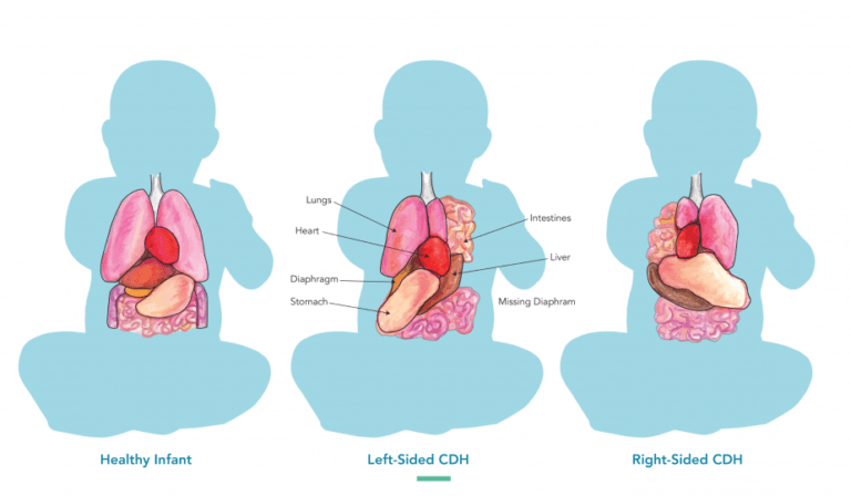 CDH Research International - Congenital Diaphragmatic Hernia